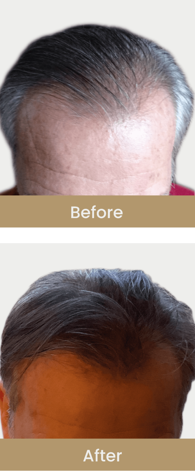 Before & After - Auralia